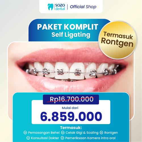 Jual Paket Behel SELF LIGATING Komplit: Pemasangan Rahang Atas dan ...