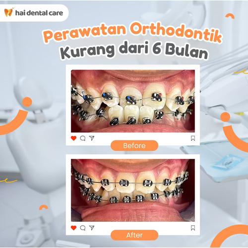 Promo Pemasangan Behel Orthodontic Bagian Atas & Bawah - Metal Premium ...