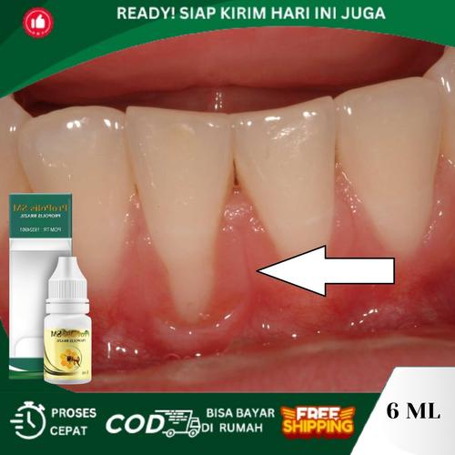 Jual Gusi Turun, Kumur Untuk Gusi Turun Ke Bawah, Gusi Mengelupas Dari ...