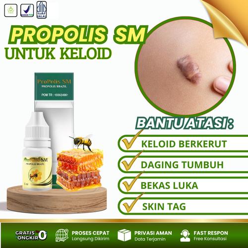 Promo Obat Tetes Propoli SM Untuk Keloid, Keloid Berkerut, Daging Tumb ...