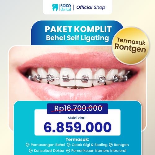Promo Paket Behel SELF LIGATING Komplit: Pemasangan Rahang Atas dan ...