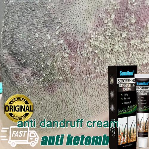 Promo Obat Penghilang Gatal di Kulit Kepala Akibat Infeksi Jamur ...