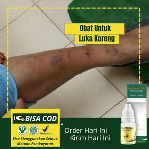 Jual Obat Koreng Bernanah Untuk Anak Tradisional - Herbal Koreng Berair ...