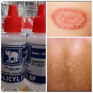 Jual Salicyl sp Cair panu kadas kurap Salisil spirtus obat panu kadas ...