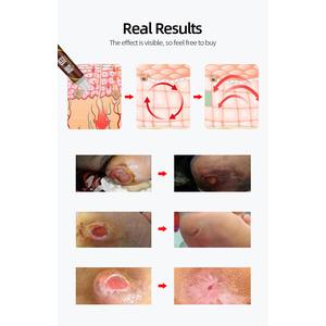 Jual Bedsores Wound Healing Cream Pressure Sores Ulcer Festering ...