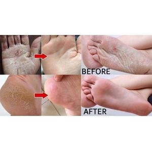Jual Krim Kaki Anti-retak Herbal Masker Kaki Anti-beku Retak Anti ...