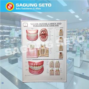Promo POSTER TEETH DENTAL CARIES AND PERIODONTAL DISEASE 3D / POSTER ...