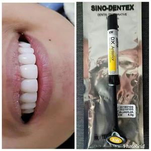 Jual Dental Composite Dentex Anterior XW Use Veneer tambalan gigi ...