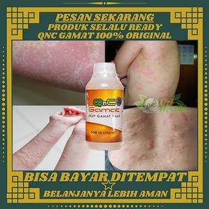 Jual Obat Biduran Kronis Herbal Kulit Gatal Merah Bentol Bentol ...