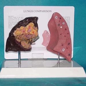 Jual Model Anatomi Smoking Lung and Normal Comparison Model Anatomy ...