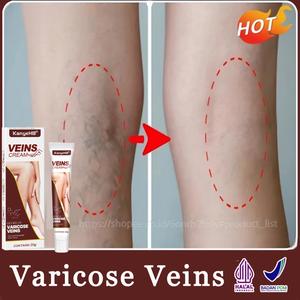 Jual KanyeHB Maikang Cream Varicose Veins obat varises di kaki dan ...