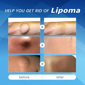 Jual IMPORT 8pcs Lipoma Removal Patch Reduce Inflammation Subcutaneous ...