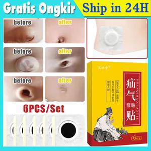 Jual 6pcs Herbal Hernia Anak Patch / Umbilical Hernia Belt Baby / Anti ...