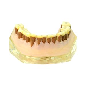 Jual Periodontitis Teeth Model Dental Teeth Model Dental Demonstration ...