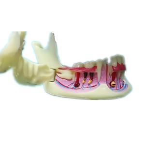 Jual Dental mandible model Endodontic Treatment Model Anatomy of gums ...