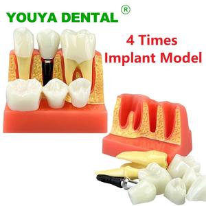 Jual Dental Implant Model 4 Times Implant Analysis Crown Bridge ...