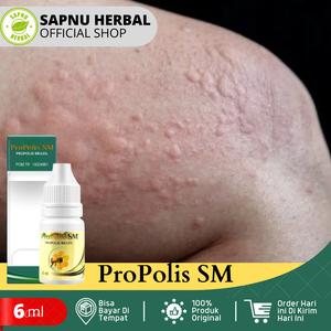 Jual Obat Biduran, Obat Ruam Merah, Obat Kaligata, Obat Gatal Kulit ...