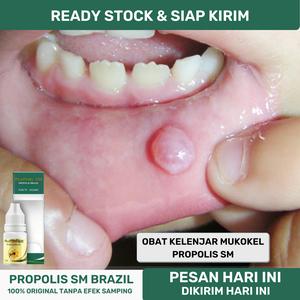 Jual Medicine Gland Mukokel, Bump On The Lower Lip, Bump On The Tongue ...