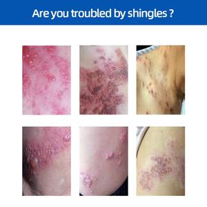 Jual Herpes Zoster Treatment Cream Shingles Skin Medication Herpes ...