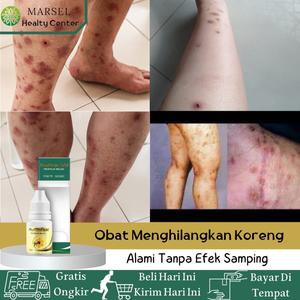 Jual Obat Koreng Di Kaki, Obat Luka Koreng, Obat Koreng Bernanah, Obat ...