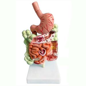 Jual Human Large Intestine Pathological Model Gastrointestinal ...