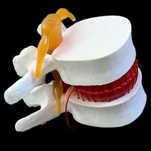 Jual Human Anatomical Lumbar Disc Herniation Model Medical Anatomical ...