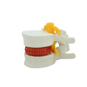 Jual Human Anatomy Skeleton Spine Lumbar Disc Herniation Teaching Model ...