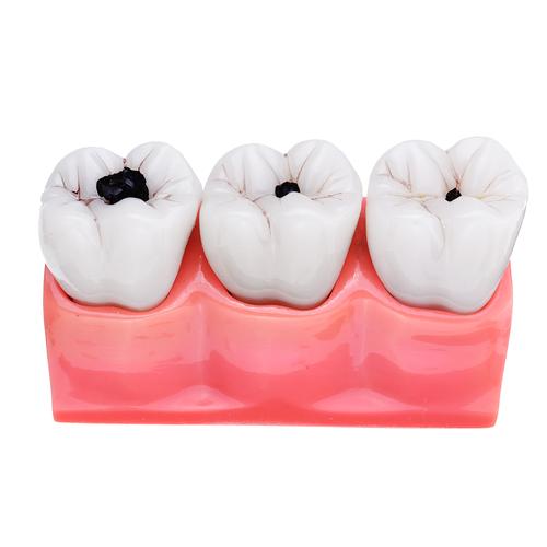 Jual 4X Detachable Human Dental Caries Teeth Tooth Decay Comparison ...
