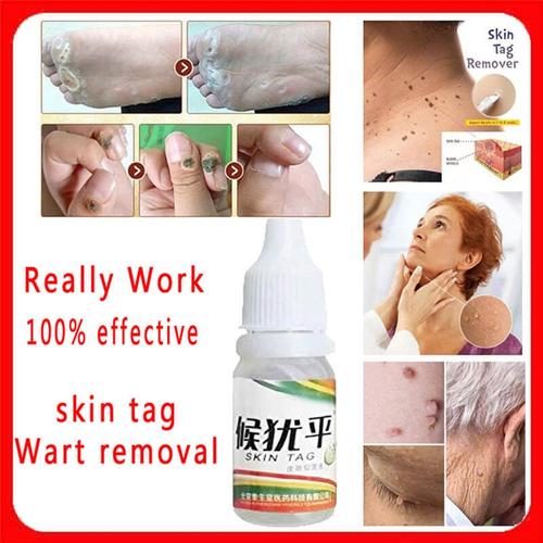 Jual Skin Tag Remover Body Warts Treatment Foot Corn Removal Plantar ...