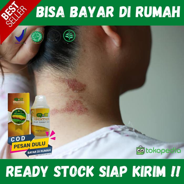Jual Obat Dermatitis Atopik, Dermatitis Seboroik, Tinea Capitis - Kab ...