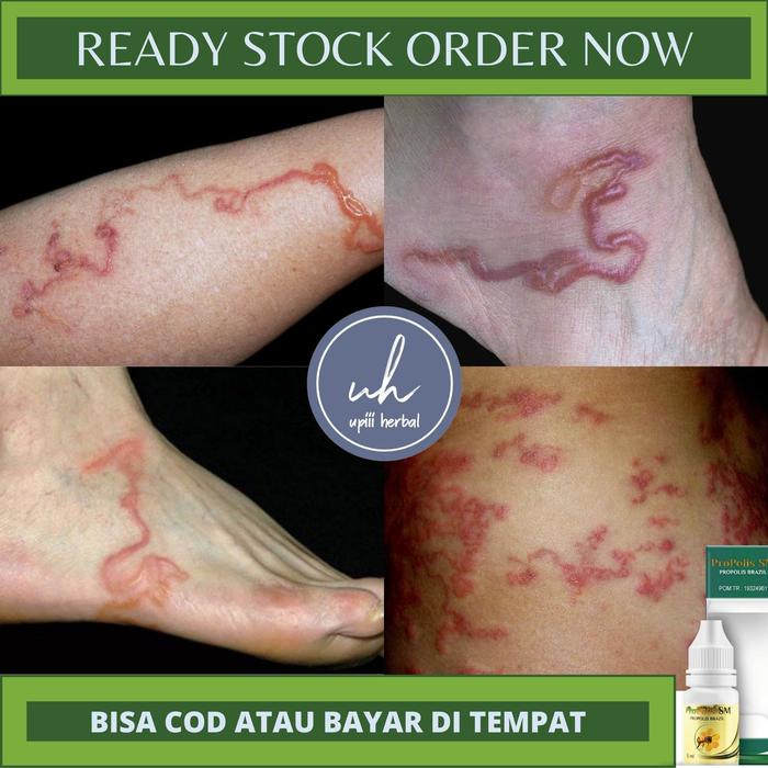 Jual OBAT CACING PASIR,CUTANEOUS LARVA MIGRANS,CACING TAMBANG,PITA,DLL ...