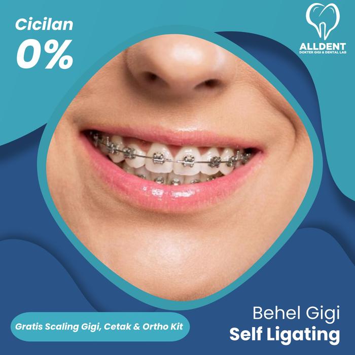 Jual Behel Gigi Self Ligating - Kota Tangerang - Alldent | Tokopedia