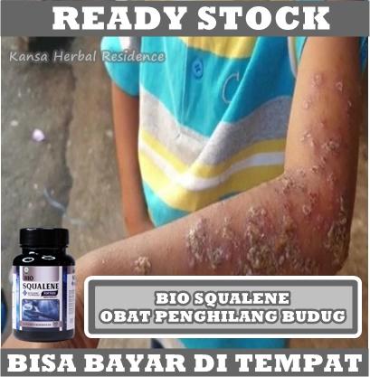 Jual Obat Scabies Manusia, Gatal Scabies Manusia, Penghilang Bekas ...