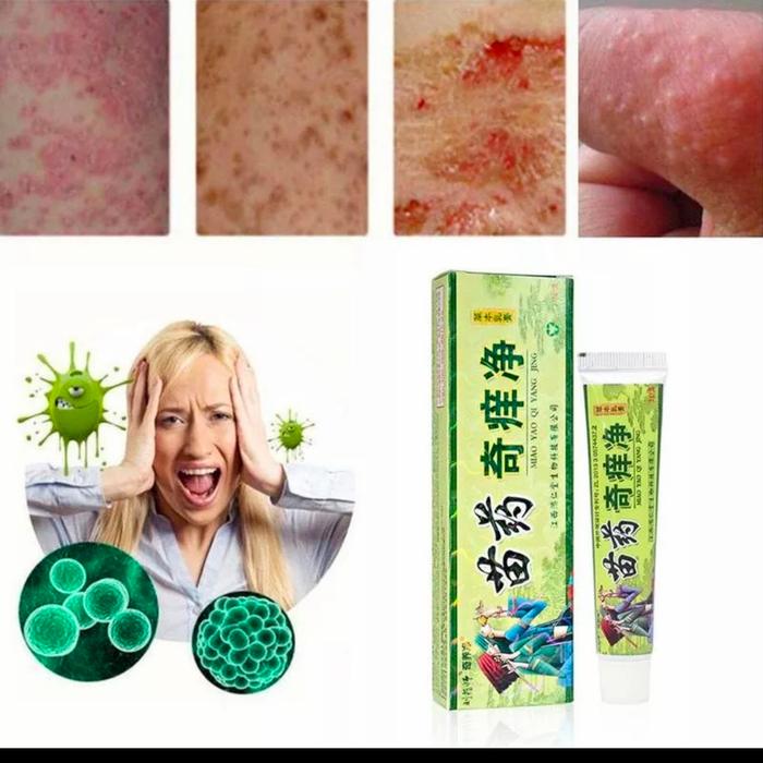 Jual Psoriasis Gatal Krim Dermatitis Eksim Salep China Obat Krim Kulit ...