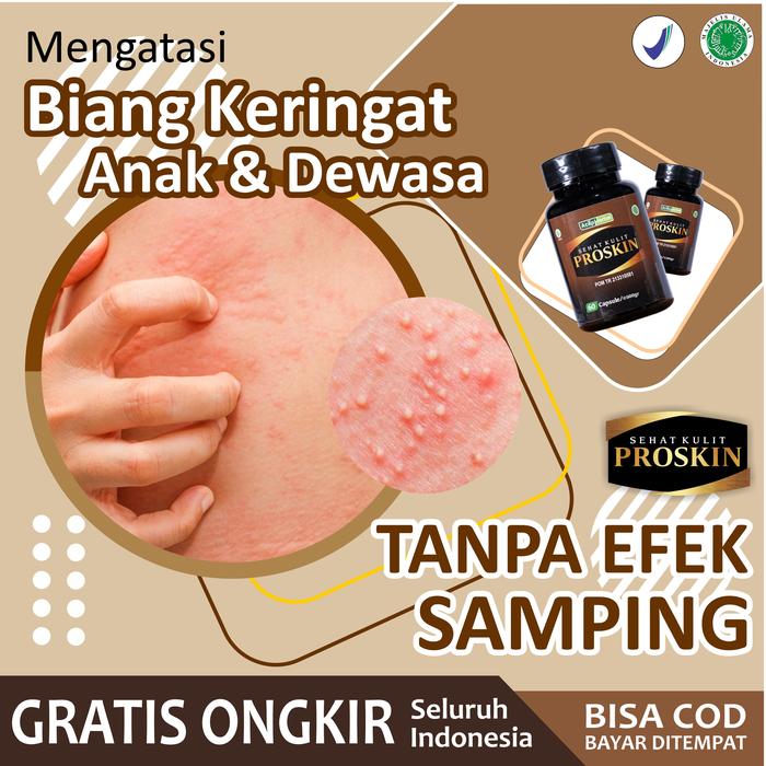 Jual PROSKIN Obat Gatal Biang Keringat Alami Anak Dan Dewasa No ...
