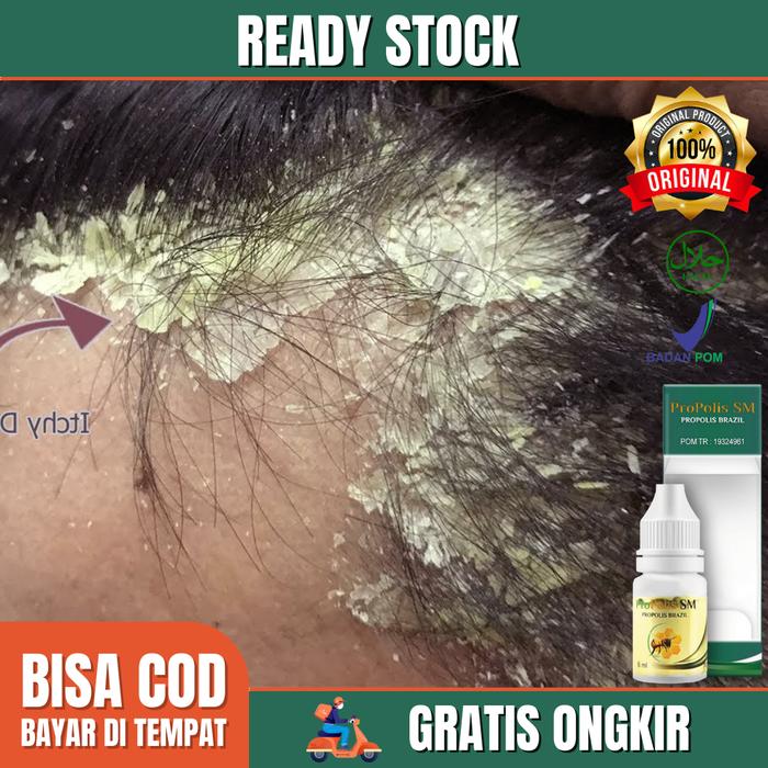 Jual Obat Kulit Seboroik Dermatitis, Tinea Capitis, Cradle Cap ...