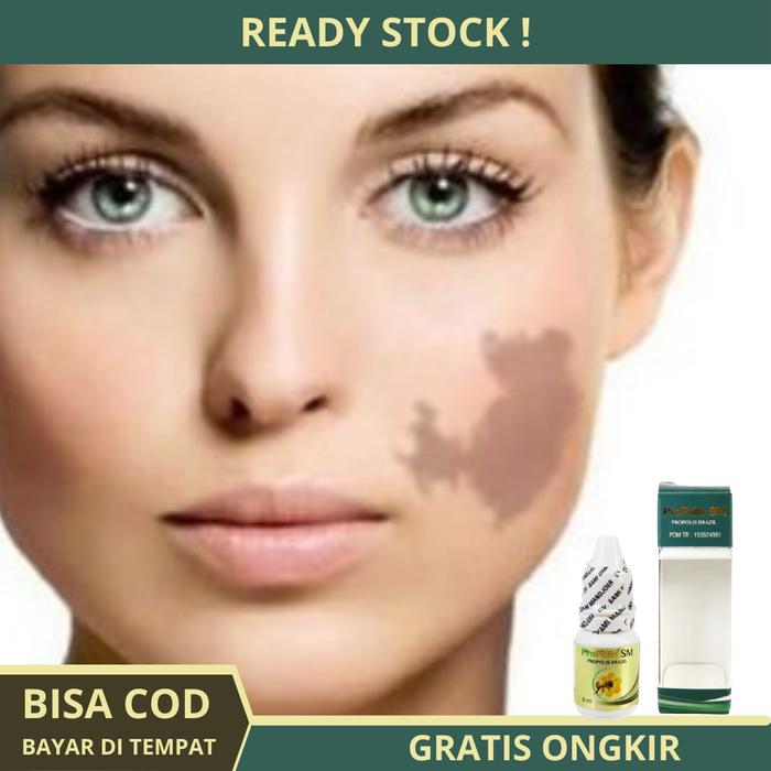 Jual Obat Penghilang Tompel, Penghilang Tanda Lahir Coklat, Hitam ...