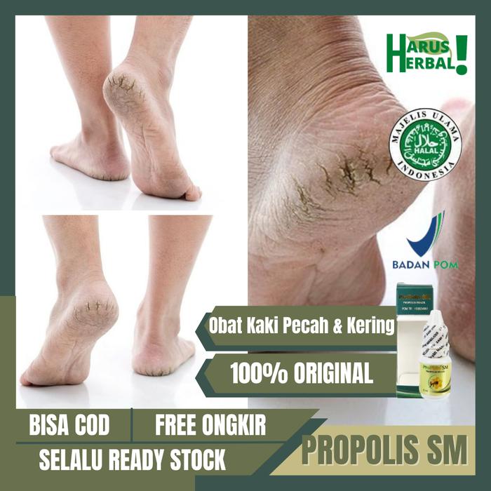 Jual Obat Tumit Kaki Pecah dan Kering, Obat Telapak Kaki Kering ...