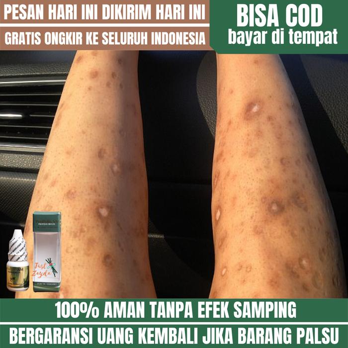 Jual Obat Budug Bernanah, Koreng Di Kaki, Budug Dan Gatal, Scabies ...