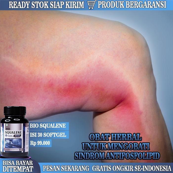 Jual Obat Sindrom Antifosfolipid, Obat Penyakit Pembekuan Darah Alami ...
