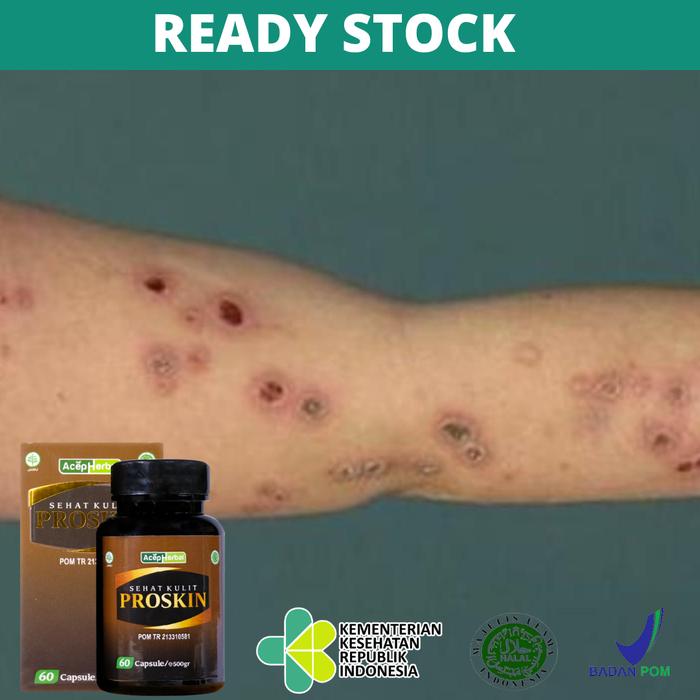 Jual Obat Gatal Prurigo, Obat Darah Manis, Bintil-Bintil Bernanah ...