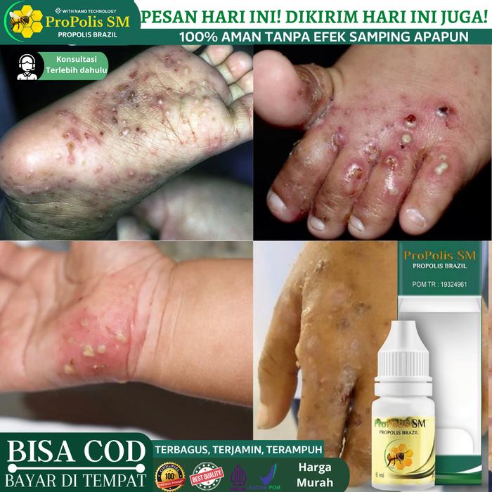 Jual Obat tetes salep cenang, budug, Borok, Luka koreng, Scabies ...