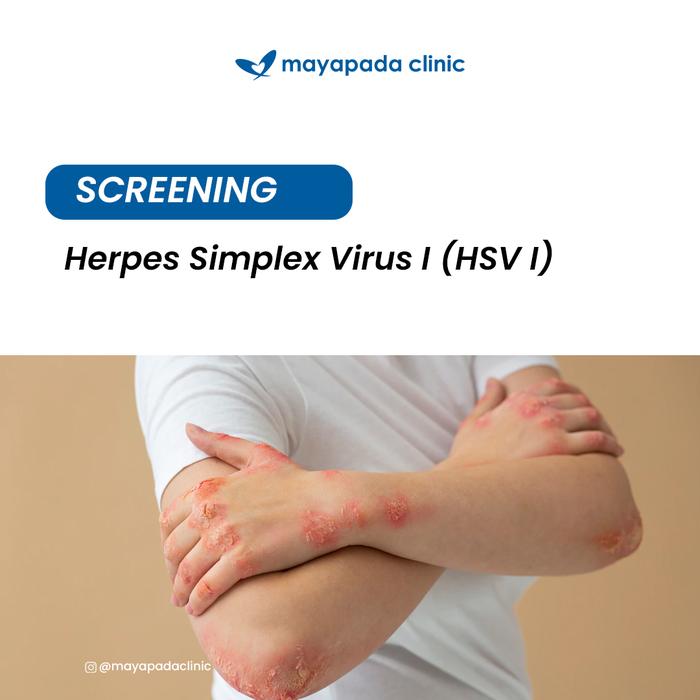 Promo Screening Herpes Simplex Virus I (HSV I ) Cicil 0% 3x - Jakarta ...