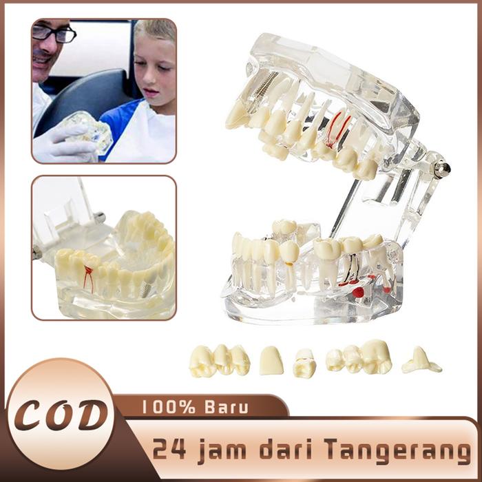 Jual Dental Study Model Gigi Removable Phantom Gigi Implant - Kota ...