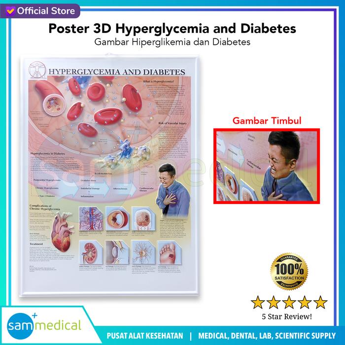 Jual Poster 3D Hyperglycemia and Diabetes BS 140 - Kota Bandung - SAM ...