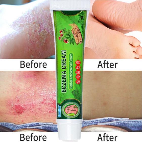 Jual eczema cream Salep Anti Gatal Salep Kulit Eksim Ruam Dermatitis ...