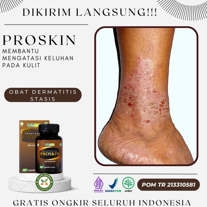 Jual Proskin Obat Dermatitis Statis, Dermatitis Seboroik, Dermatitis ...