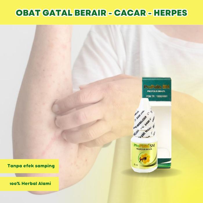 Promo Obat Jari Tangan Berair Cacar Air Herpes Zoster Bernanah dan ...