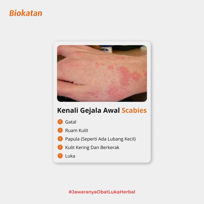 Jual Biokatan, Obat Scabies, Buduk, Kudis, Gudik Pesantren manjur dan ...