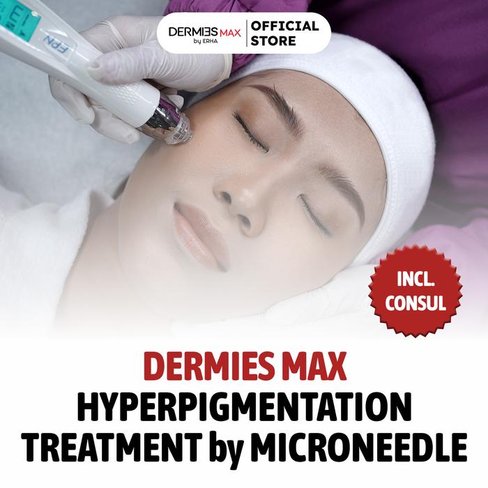 Promo Dermies Max Hyperpigmentation treatment by Microneedle Cicil 0% ...